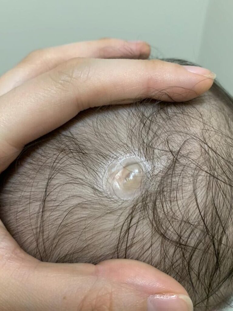 Aplasia Cutis Congênita - Dra. Desiree Lee
